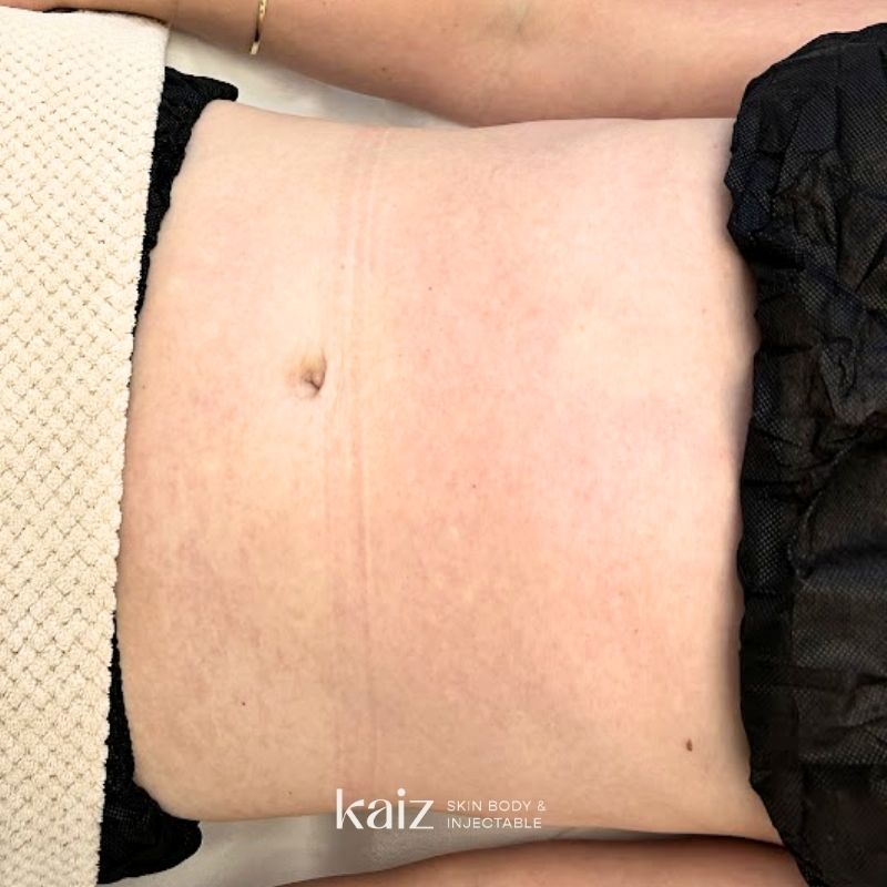 Kaiz Wellness Medispa | Advanced Aesthetics, Parnell Auckland
